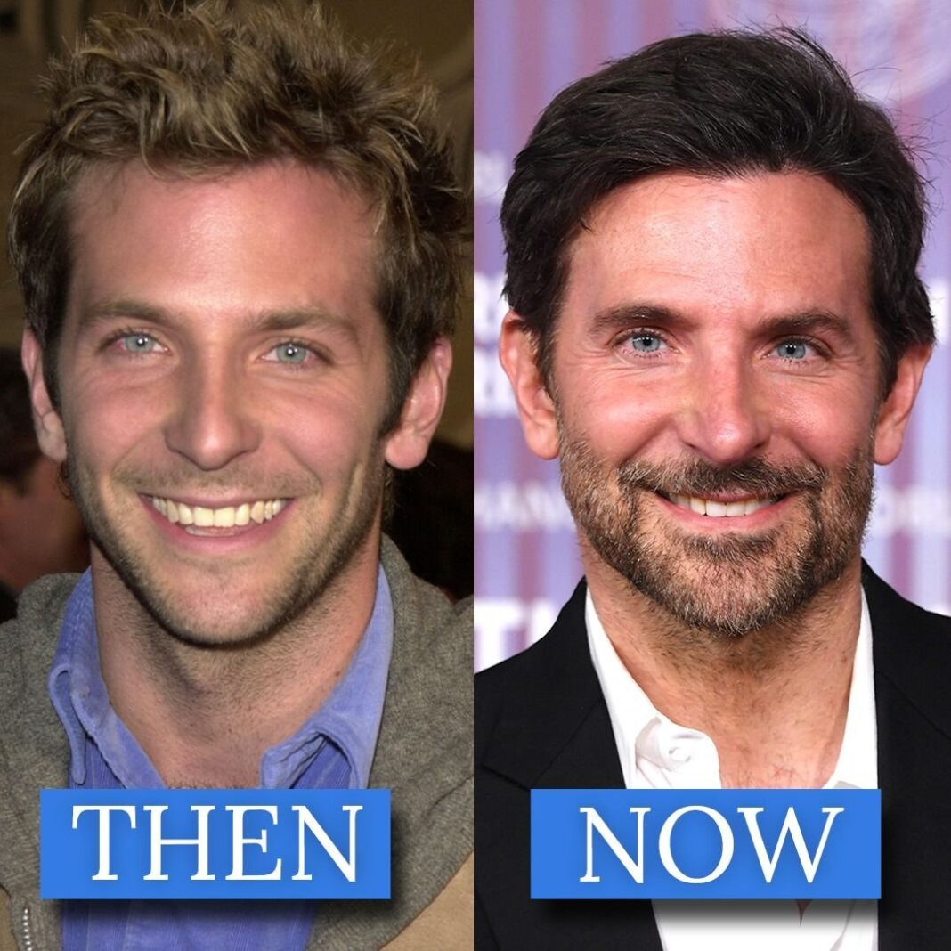 Bradley Cooper prima e dopo: a 50 anni col viso “disteso”